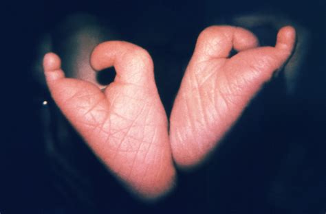 Ectrodactyly Ectodermal Dysplasia