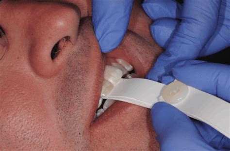 When Your Occlusal Clearance Disappears Ignitedds