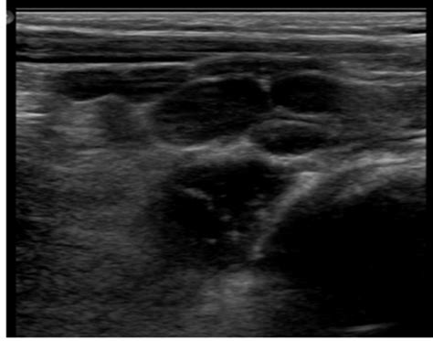 Ultrasound Image Shows Enlarged Lymph Nodes In The Right