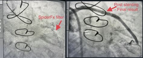 87 Year Old Female With Post Cabg Rest Angina Cme India