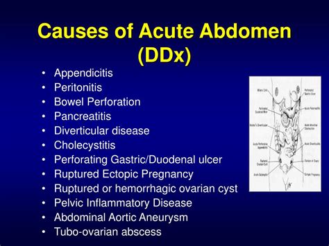 Ppt The Acute Abdomen Powerpoint Presentation Id173923
