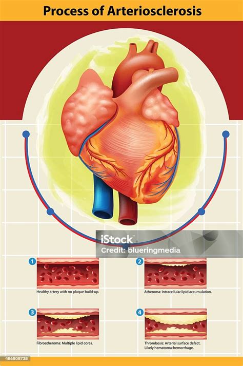Poster Proses Arteriosklerosis Ilustrasi Stok Unduh Gambar Sekarang Poster Proses Arteriosklerosis Ilustrasi Stok Unduh Gambar Sekarang