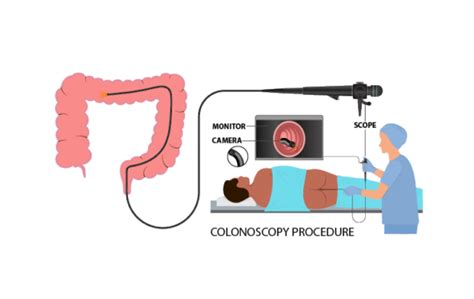 Getting A Colonoscopy Bowel Prep Instructions Grady Health