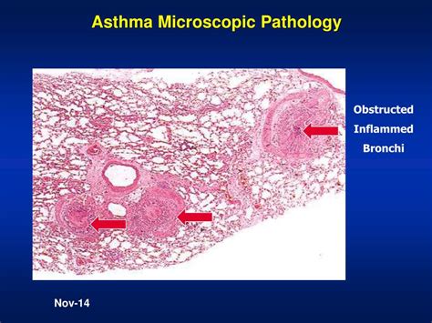 PPT Bronchial Asthma Definition Patho Physiology Diagnosis Management
