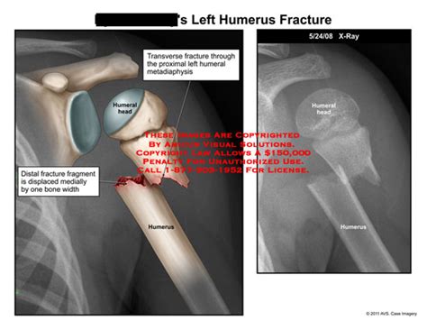 AMICUS Illustration Of Amicus Injury Arm Humerus Fracture Transverse