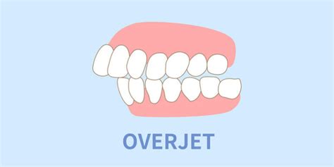 What Is An Overjet Golden Mile Dental 16474906888