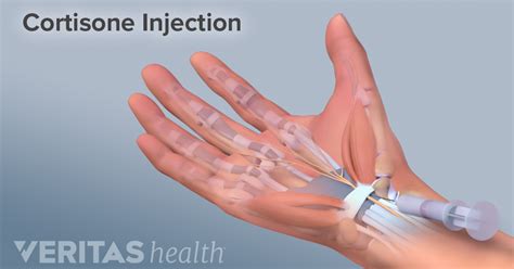 Cortisone Injections Steroid Injections