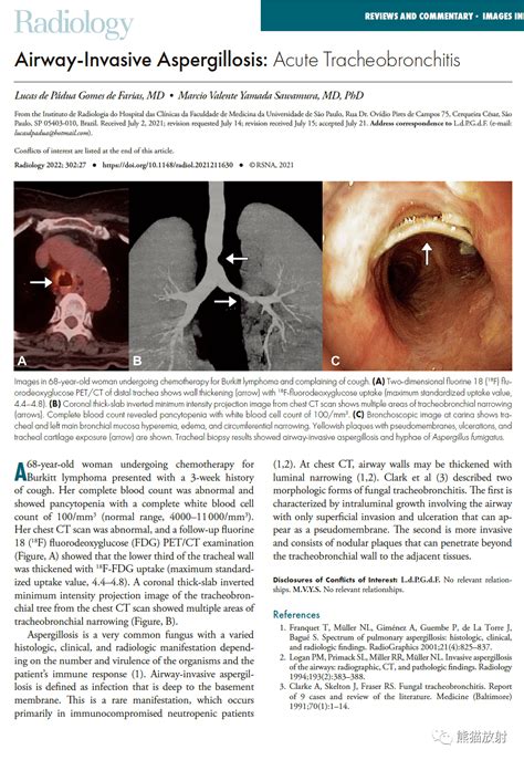 CASE丨Airway Invasive Aspergillosis Acute Tracheobronchitis 侵袭 气管 免疫