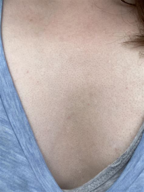 Overview For Unreadable Rach