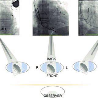 Rao Projection At 30° Showing An Inserted Right Atrial Lead A Fixed
