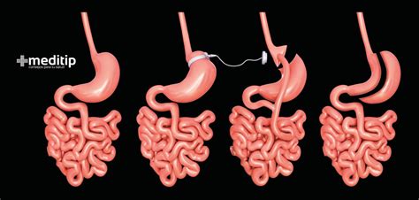 Cirugía Bariátrica Definición Diferencias Y Beneficios Meditip