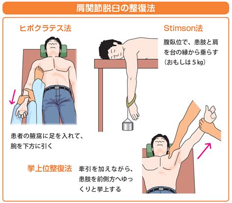 肩関節前方脱臼整復 ほんごう接骨院