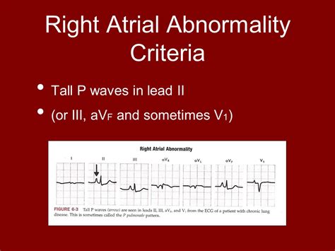 Atrial Enlargement On Ekg