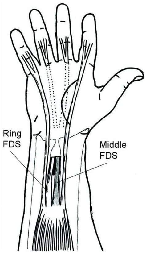 Pin On Radial Nerve Transfers