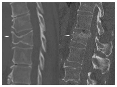 Radiological Diagnosis And Advances In Imaging Of Vertebral Compression Fractures