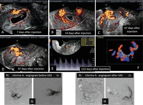 A Consequence Of Cesarean Delivery First Trimester Cesarean Scar