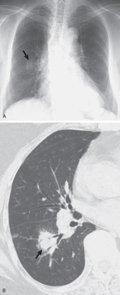 Hodgkin Lymphoma Radiology Key