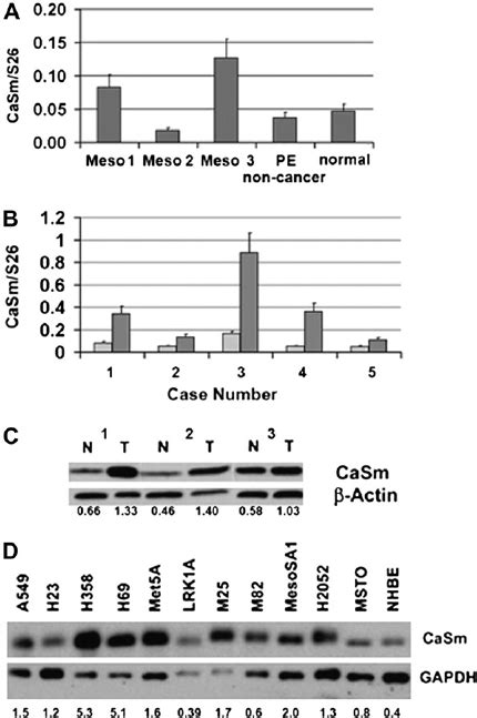 Casm Mrna And Protein Are Expressed At Higher Level In Mesothelioma And