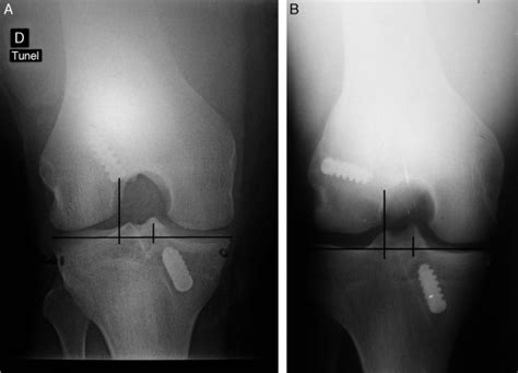 A B Measurement Of The Femoral And Tibial Tunnel Positioning In The Download Scientific