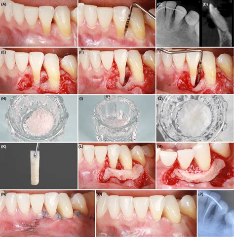 Regenerative Treatment Of An Infrabony Defect Using Rhpdgf‐bb A B Download Scientific