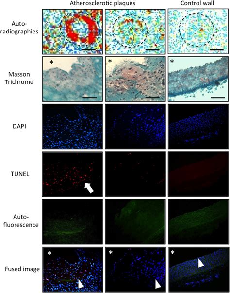 Detection Of Apoptotic Cells In A Rabbit Model With Atherosclerosis Like Lesions Using The