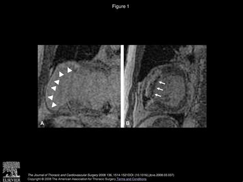 Use Of Quantitative Analysis Of Remote Myocardial Fibrosis With Delayed