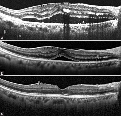 Retinal Vasoproliferative Tumor Regression After Intravitreal