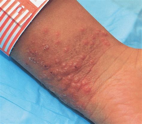 Dyshidrotic Eczema Arms