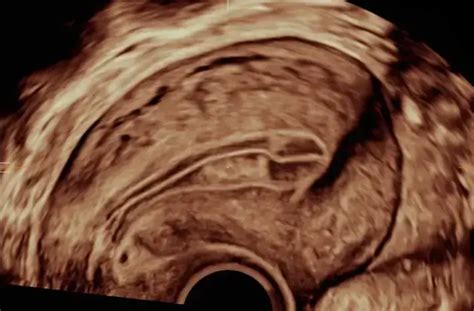 Uterine Assessment Gynecology Voluson™ Ultrasound