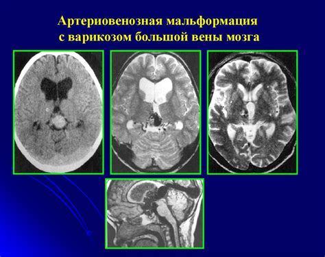 Лучевая диагностика КТ и МРТ заболеваний сосудов головы сосудистые