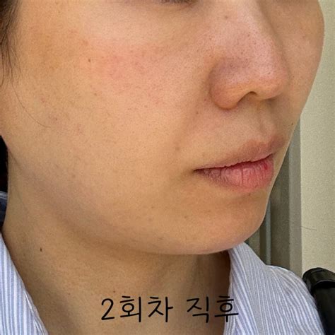 쥬베룩 볼륨 가격 부작용 효과 팔자 광대 통증 후기 네이버 블로그
