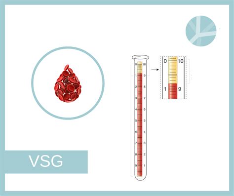 Alejandro Macias On X La Velocidad De Sedimentación 52 Off