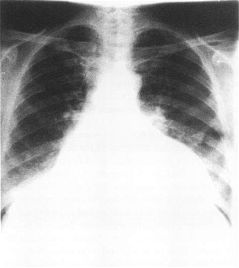 Chest Radiograph Before Partial Left Ventriculectomy Indicates Massive Download Scientific