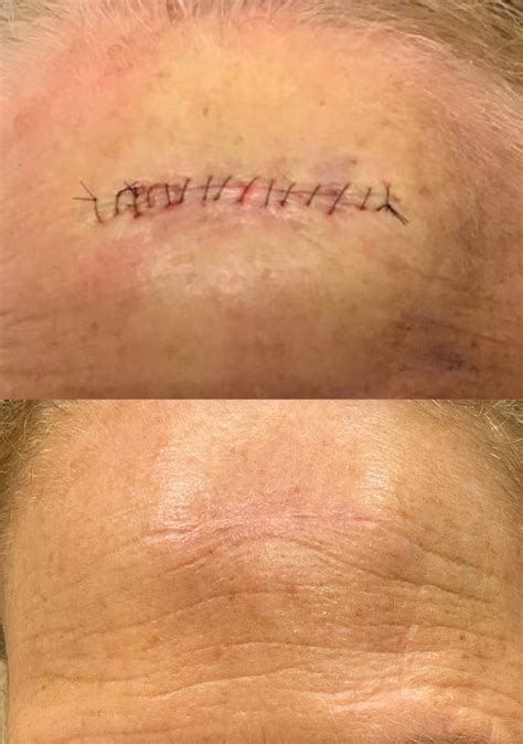 Top Mohs Micrographic Surgeon In New York Ariel Ostad Md Facs