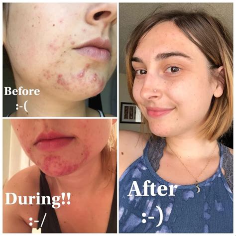 Tretinoin Cream Before And After