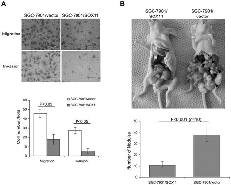 The Metastasis Suppressor Sox11 Is An Independent Prognostic Factor For