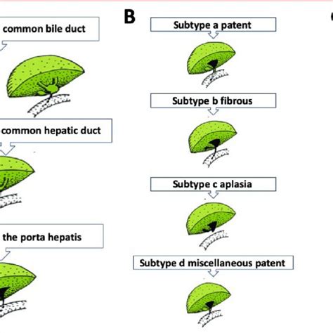 PDF Outcomes Of Paediatric Liver Transplant For Biliary Atresia