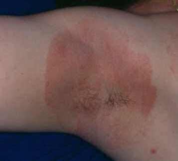 Health Teller Eritrasma