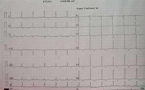 Lvh Vs Ischemia Drsvenkatesan Md