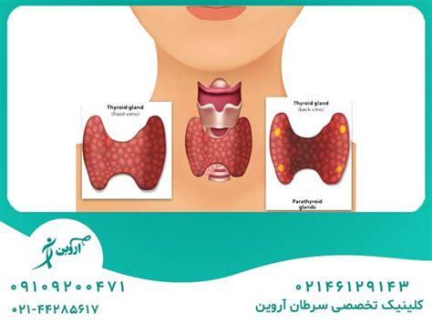 سرطان پاراتیروئید چیست علائم سرطان پاراتیروئید عوارض