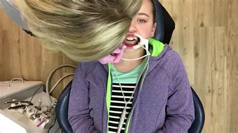 Braces On Time Lapse Youtube