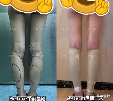 吸脂，如何才能找到一个好医生呢？ 知乎