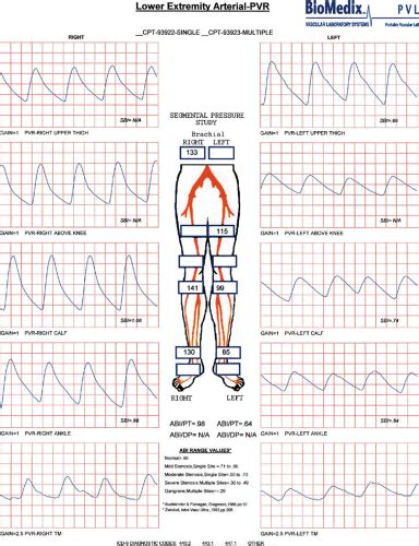Noninvasive Assessment Of Peripheral Vascular Disease Thoracic Key