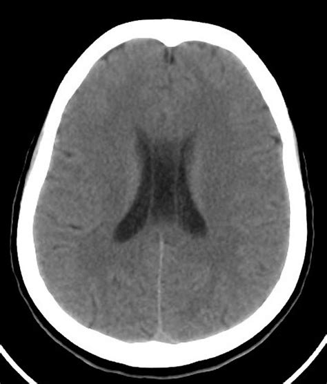 Cavum Septum Pellucidum Et Vergae