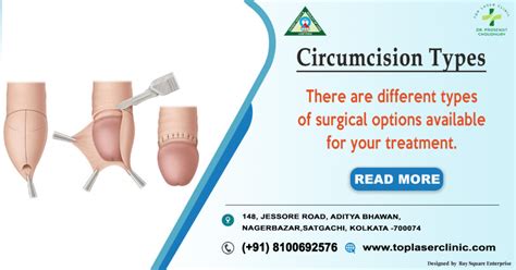 Circumcision Techniques A Comprehensive Guide To Different Types