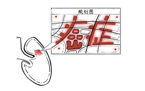 体检查出结节，离癌症还有多远？ 知乎
