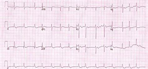 Digoxin Salvador Dali Mustache Ecg