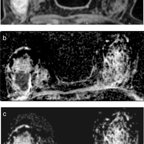 A 65 Year Old Woman With Invasive Ductal Carcinoma Of The Right Breast