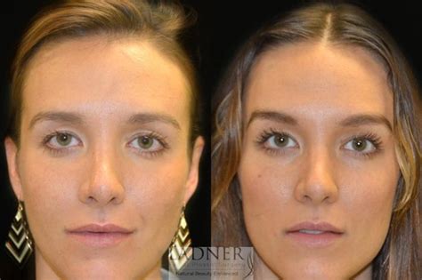 Botox For Your Forehead Before And After Results