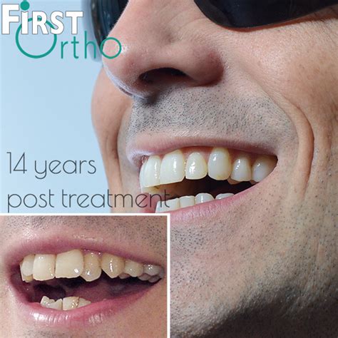 Severe Crowding 14 Years After Braces First Ortho